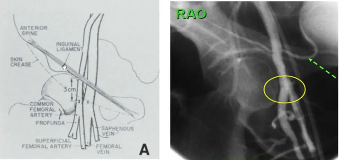Thực trạng biến chứng liên quan đến vị trí đường vào mạch máu trong ...
