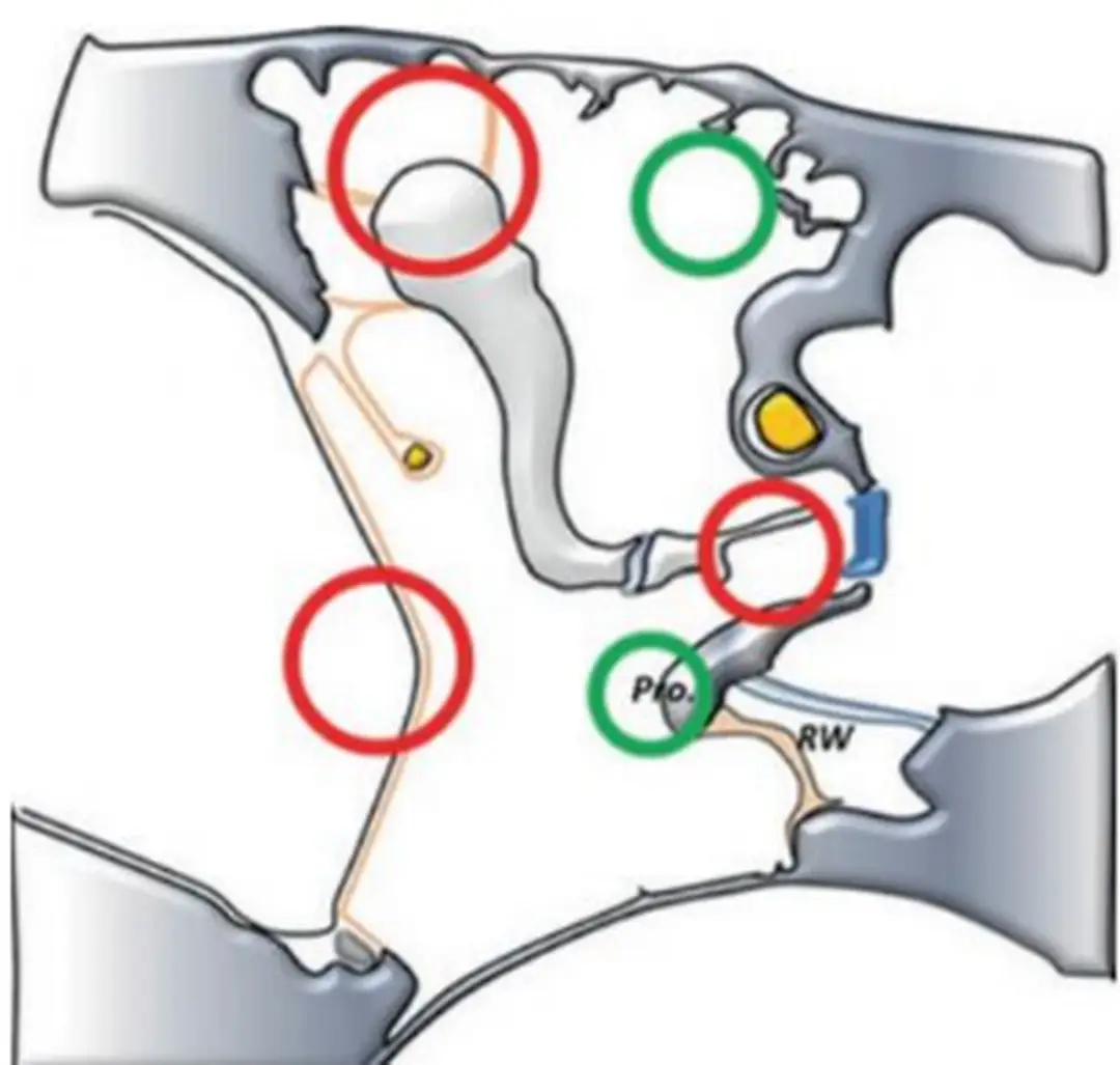 Chẩn đoán và điều trị Xơ nhĩ trong tai mũi họng 2021