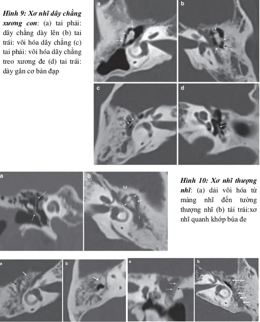 Chẩn đoán và điều trị Xơ nhĩ trong tai mũi họng 2021