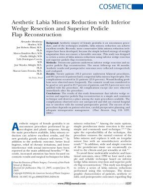 Aesthetic Labia Minora Reduction with Inferior Wedge Resection and ...